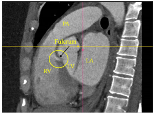 The Cardiac Fulcrum-Comments