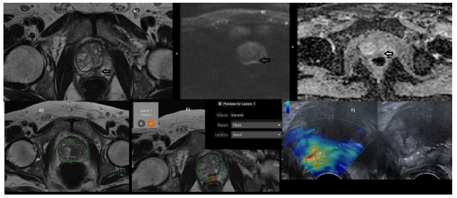 Comparison of AI-Based and Manual Reader Evaluation of Biparametric MRI ...