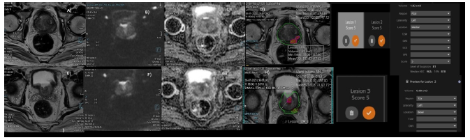 Comparison of AI-Based and Manual Reader Evaluation of Biparametric MRI ...